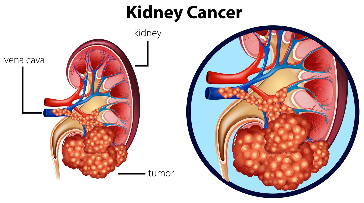 Kidney Cancer Specialist Melbourne | Renal Tumour Surgery | A/Prof Homi ...