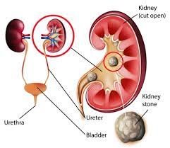 Kidney Stones | The Urology Institute
